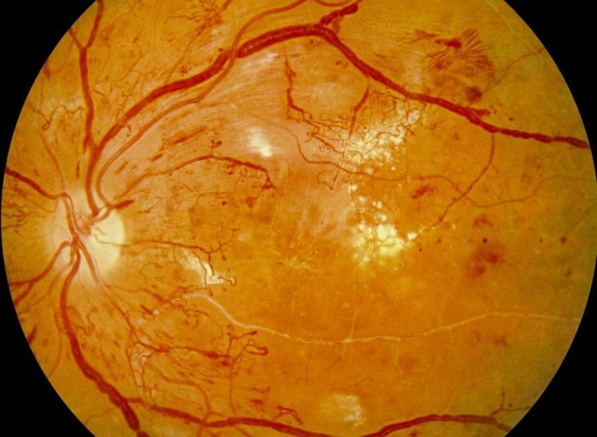 Panretinal photocoagulation (PRP therapy) | MyVisionCare.org