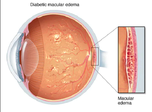 Diabetic macular edema | MyVisionCare.org